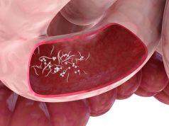 Vermi intestinali (ossiuri): cause, sintomi e terapie - Sanioggi.it