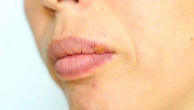 Infiammazione delle labbra o cheilite: cause, sintomi e cure - Sanioggi.it