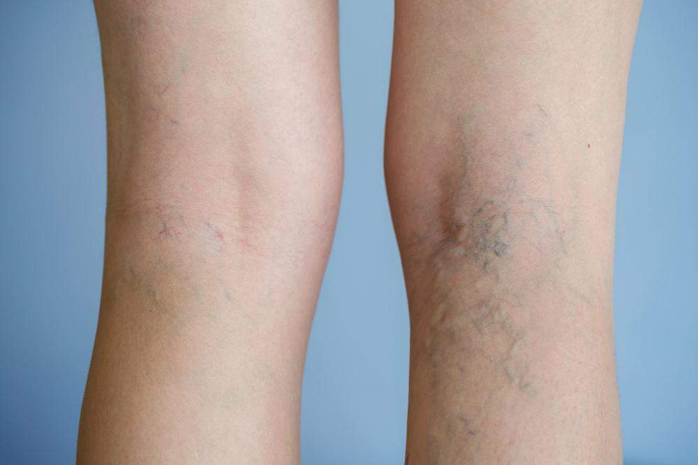 Insufficienza Venosa Cause Sintomi Terapia E Rimedi Sanioggi it Insufficienza Venosa Cause Sintomi Terapia E Rimedi Sanioggi it