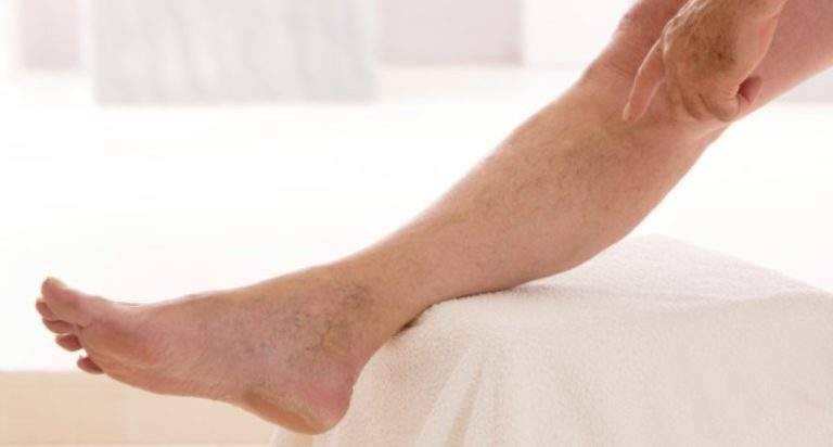 Flebite superficiale o profonda: cause, sintomi e cure - Sanioggi.it