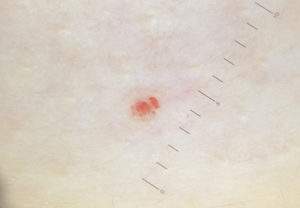 Angioma: cause, quando preoccuparsi, sintomi e cure - Sanioggi.it