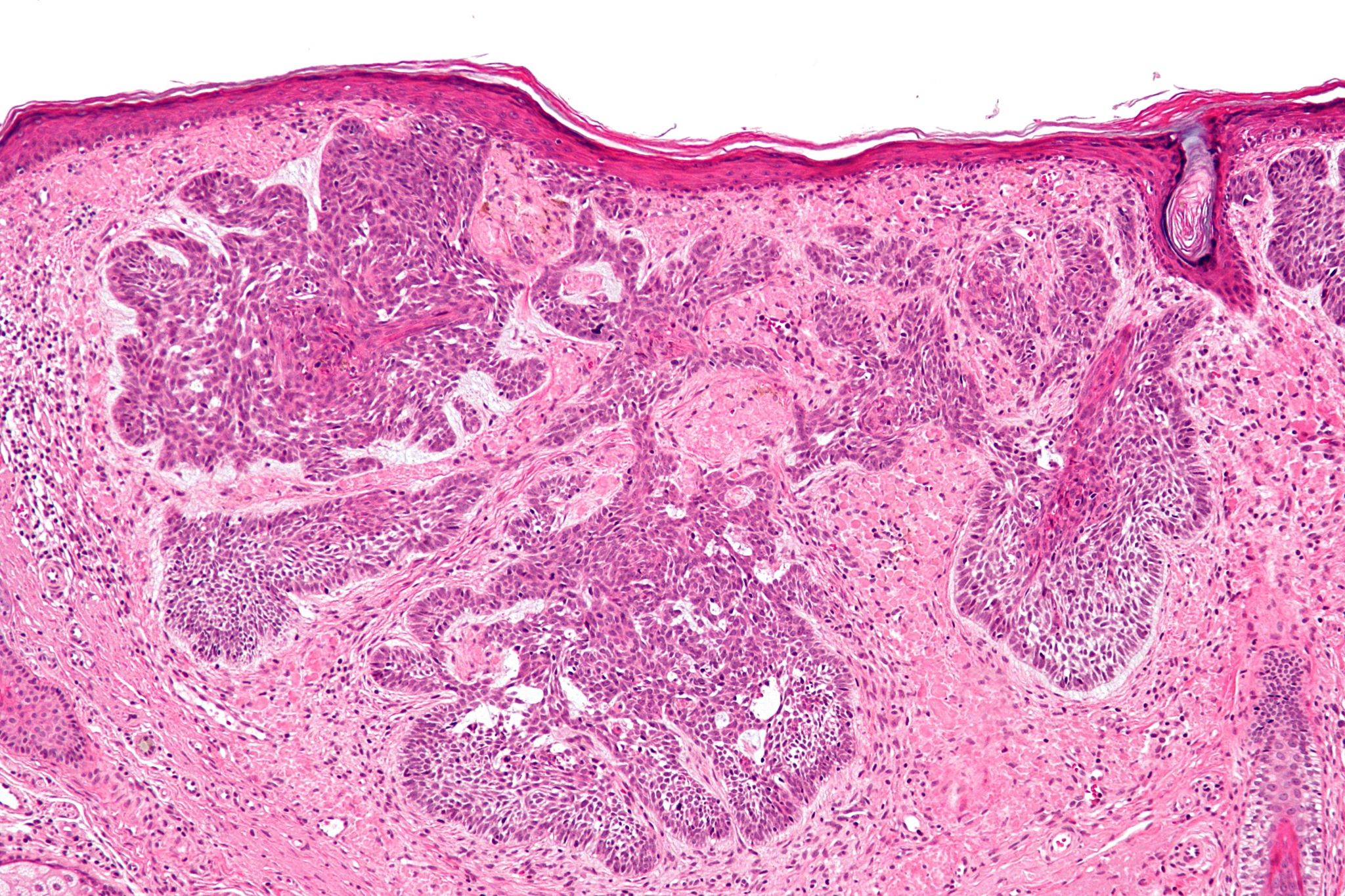 Basalioma o carcinoma basocellulare: cos'è, cause, sintomi e ...